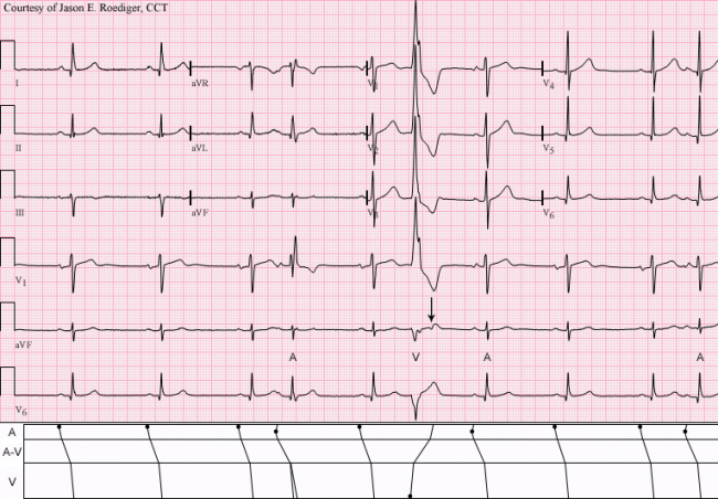 rabbit-ear-sign-ecg-guru-instructor-resources